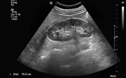 Ecografia Renale A cosa Serve perchè Farla - Radiologia Italia